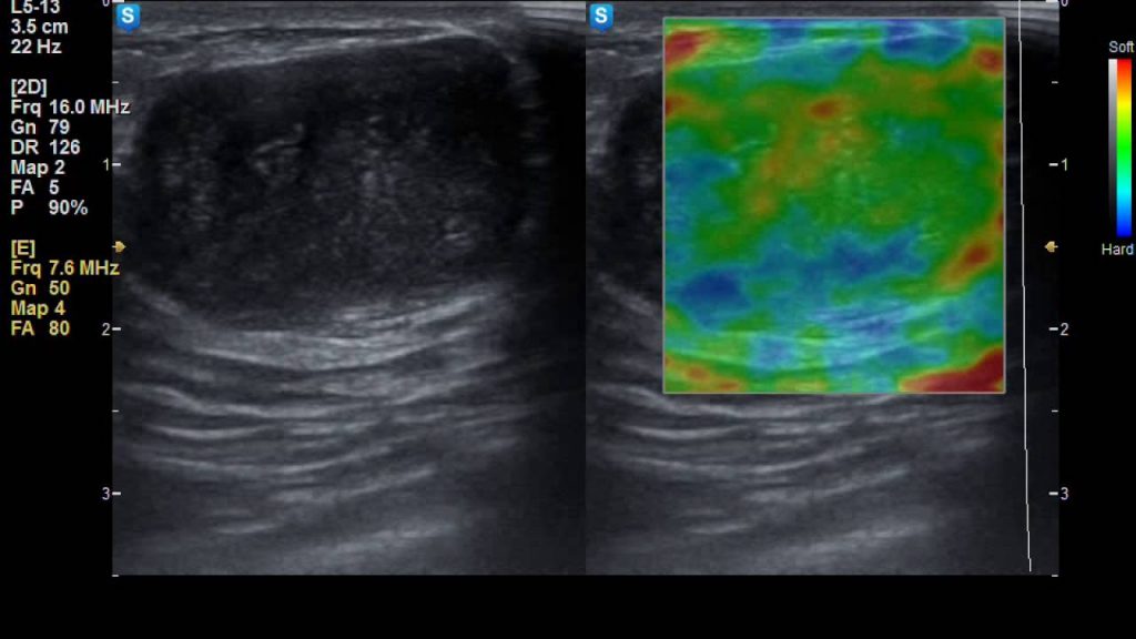 Elastoscan Elastografía En Diagnóstico De Mamas Adv Medical